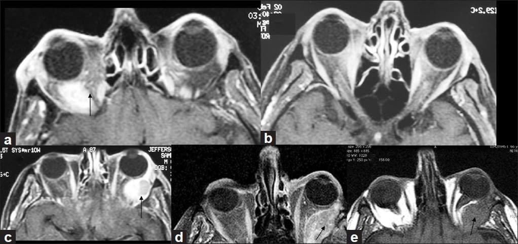 Orbit and Tumors - Axis Eye Clinic
