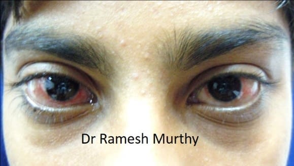 Best Pediatric ophthalmologists in Pune - Axis Eye Clinic