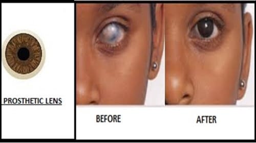 Contact Lens - Axis Eye Clinic