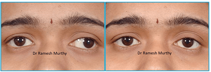 Best Squint Surgeon in Pune | Squint Treatment in Pune - Axis Eye Clinic