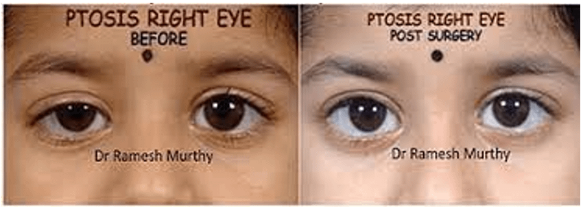 What to Do About Ptosis | Dr. Ramesh Murthy