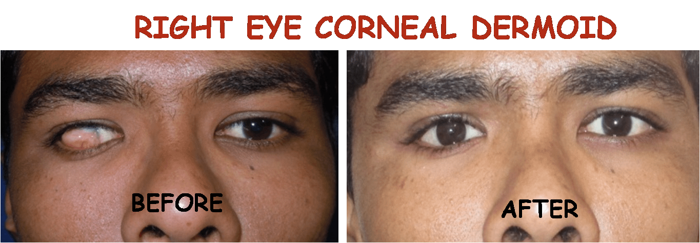 Prosthetic Eye Service - Axis Eye Clinic