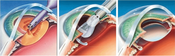 Cataract Surgery - Axis Eye Clinic
