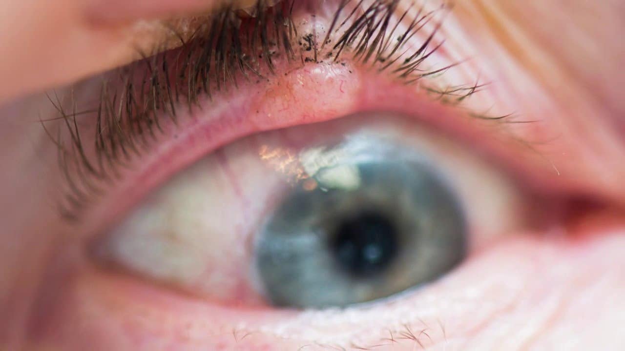 Eyelid tumors- Dr. Ramesh Murthy