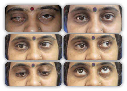 Prosthetic Eye Service - Axis Eye Clinic