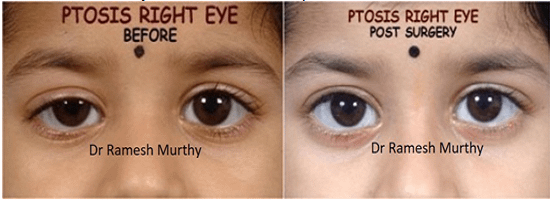 Know More About Ptosis - Dr. Ramesh Murthy