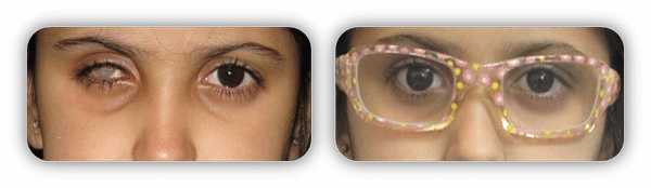 Prosthetic Eye Service - Axis Eye Clinic