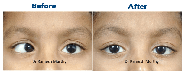 How Can Squint Surgery Be Made Successful - Dr. Ramesh Murthy