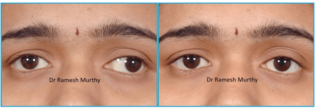 Divergent Squint - Dr. Ramesh Murthy