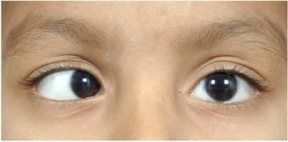 Best Squint Surgeon in Pune | Squint Treatment in Pune - Axis Eye Clinic