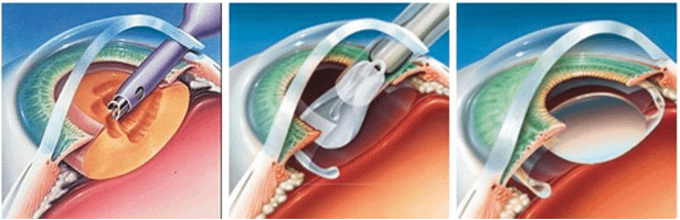 What Patients Feel During and After Cataract Surgery - Axis Eye Clinic