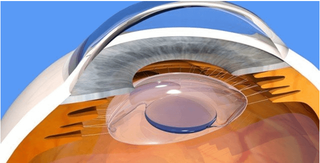 Choosing the Right Intraocular Lens - Dr. Ramesh Murthy