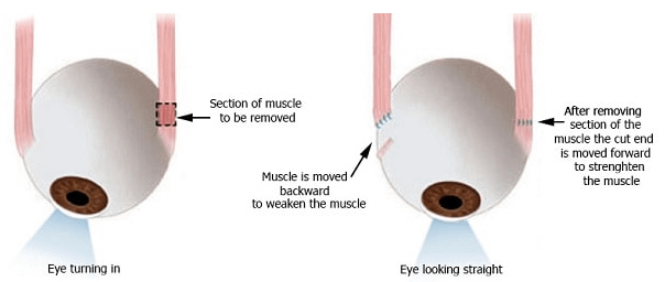 What to expect after squint surgery - Dr. Ramesh Murthy