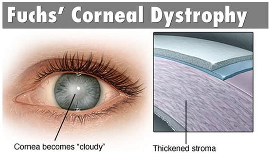 Fuchs Corneal Dystrophy - Dr. Ramesh Murthy