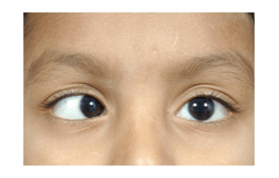 Which Is Worse Lazy Eye or Squint - Axis Eye Clinic